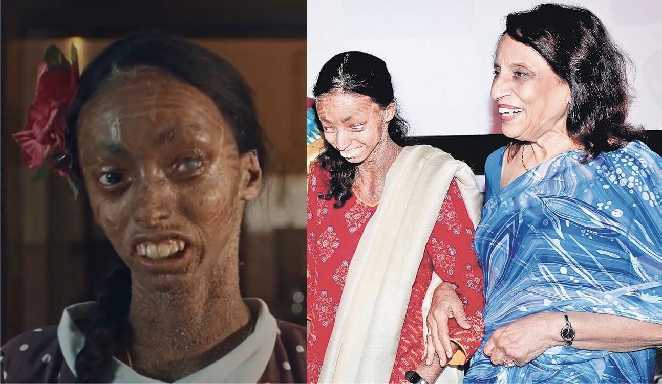 Rejected By Society Due To Rare Genetic Disease, This Is How Nisha's ...
