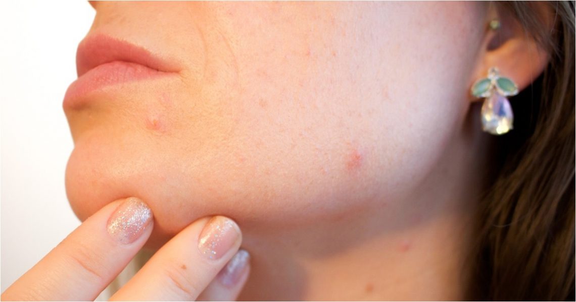 Pimples Vs Cold Sores: Differences, Causes & Treatment